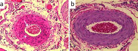 Histology Of The Treated A And Untreated B Femoral Artery