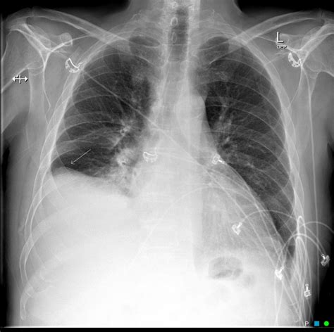 Subpulmonic Effusion Pacs