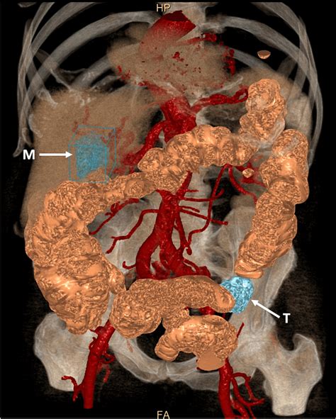 3d Modelling Intellispace Portal 10 0 Philips Healthcare Best The Download Scientific