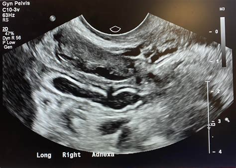 Appendicitis Seen On Transvaginal Ultrasound Rradiology