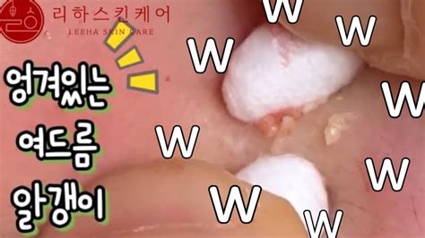 염증성여드름 ️ 엉겨있는 알갱이 모두다🫡 Youtube