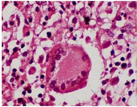 Figure 5 Tubercular Osteomyelitis Of The Mandible A Case