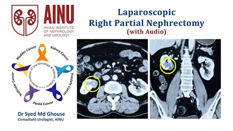 Laparoscopic Right Partial Nephrectomy With Audio Ainu Surgical Video Youtube