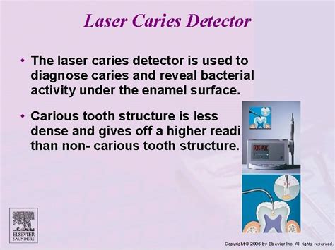 Dental Caries Chapter 13 Copyright 2005 By Elsevier