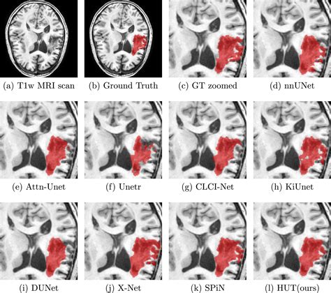 Hut Hybrid Unet Transformer For Brain Lesion And Tumour Segmentation Heliyon