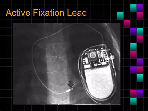 Pacemaker Radiologyanintroduction Ppt