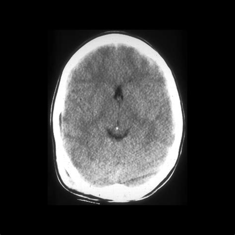 Pediatric Diffuse Cerebral Edema Pediatric Radiology Reference