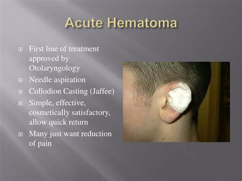 Ppt Management Of Auricular Hematoma Powerpoint Presentation Free