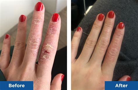 Effective Eczema Relief Gloves In A Bottle Shielding Lotion For