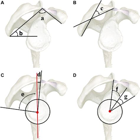 Measurements Of Scapular Bony Parameters Based On 3 Dimensional