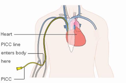 Buy PICC Lines Supplies Products ON SALE Vitality Medical
