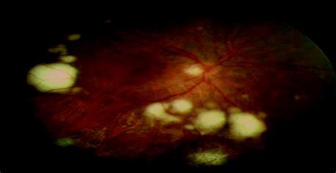 Partial Regression Of Vitreoretinal Lymphoma After Fine Need Retinal Cases And Brief Reports
