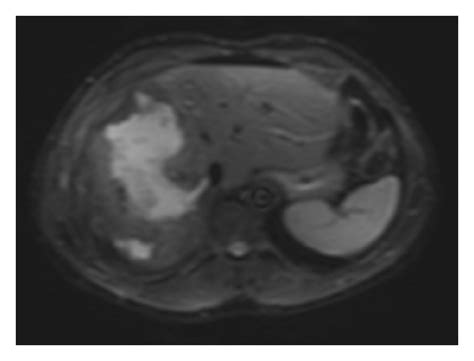 Unenhanced Ct Scan Shows An Infiltrating Hepatic Solid Mass That
