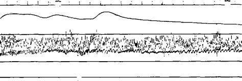 Figure 1 From Eeg Alpha Rhythm And Eyelid Flutter Semantic Scholar Figure 1 From Eeg Alpha Rhythm And Eyelid Flutter Semantic Scholar