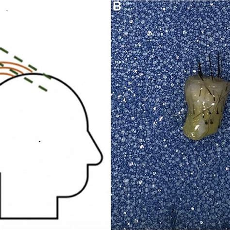 Correct Biopsy Technique A Correct Biopsy Technique Punch Is Angled