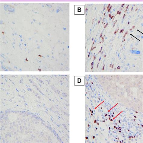Immunohistochemical Determination Of Tumour Infiltrating Cd8 And