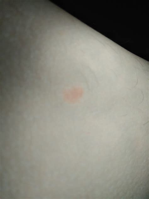 Красное пятно на коже на ноге Неделю назад обнаружила красное пятно 1 Medaboutme