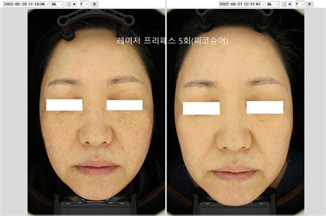 피코슈어레이저 시술 전후 다시봄날의원 서창