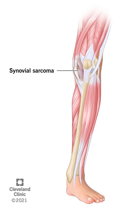 Synovial Sarcoma What Is It Diagnosis Treatment And Prognosis