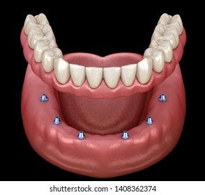 Removable Partial Denture Mandibular Prosthesis Medically Stock Illustration 2224159229