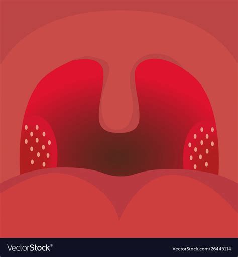Tonsilitis Sore Throat Royalty Free Vector Image