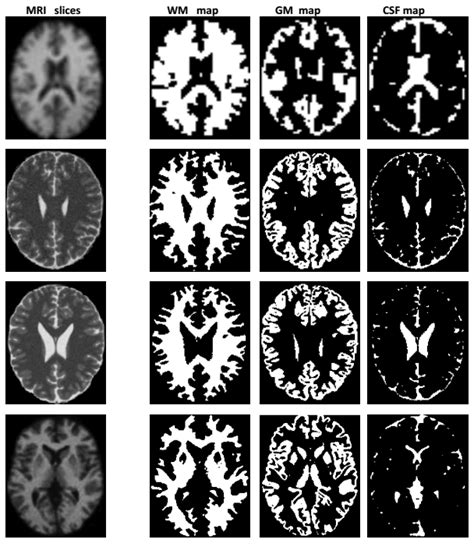 Fuzzy Maps Of Wm Gm And Csf Tissues Calculated With Pfcm Modeling Download Scientific Diagram