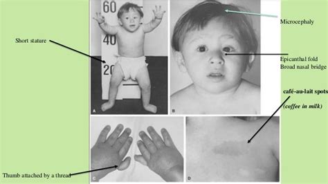 Aplastic Anemia Pediatrics