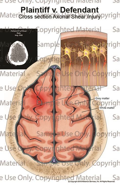 Axonal Shearing