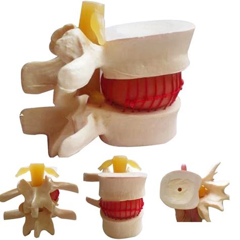 Spine Lumbar Disc Herniation Model Demonstration Medical Model £19 86 Picclick Uk