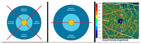 Scp Macular Vessel Density As Accurate As Rnfl Gcc Thickness In Diagnosing Poag