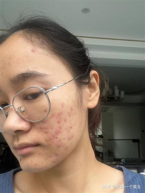 分享一下，陈年三年以上的痘印我是怎么快速去掉的 知乎