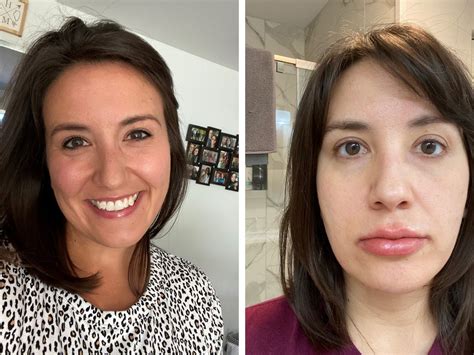 Why Do I Have Hives And Swollen Lips Why Do I Have Hives And Swollen Lips