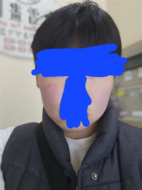 홍조 질문 에스앤유 김방순 피부과