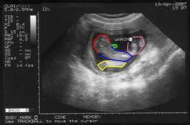 Descubrir El Sexo Del Beb A Las Semanas