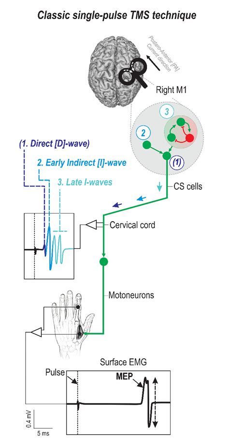 Classic Single Pulse Tms Technique A Figure Of Eight Coil Is Placed
