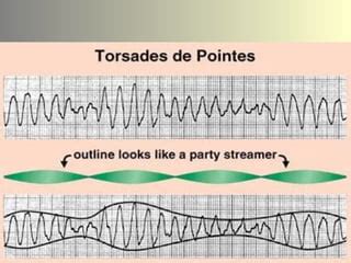 Torsades De Pointes Ppt