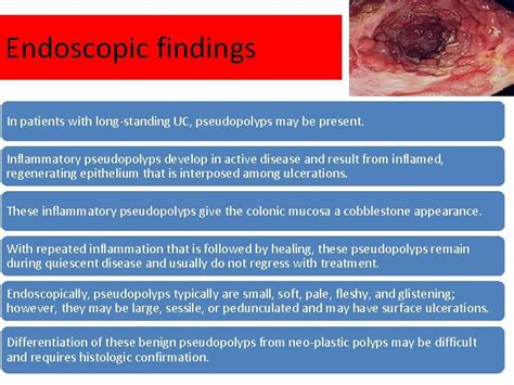 Ulcerative Colitis Disease Distribution Ulcerative Colitis Left Sided
