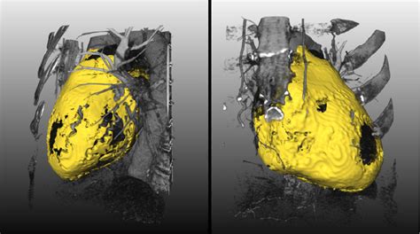 Figure 2 From Quantification Of Epicardial Adipose Tissue Eat Volume On Cardiac Ct Using A