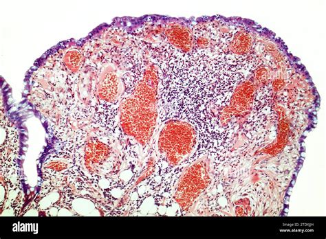 Ulcerative Colitis Light Micrograph LM Of A Section Through An Affected Tissue Ulcerative