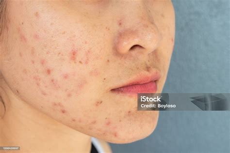 그녀의 얼굴에 여드름 염증 의 문제가있는 여성의 반 얼굴을 클로즈업 여드름에 대한 스톡 사진 및 기타 이미지 Istock