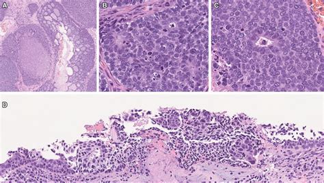 A Proliferation Of Basaloid Tumor Cells In A Predominantly Solid Growth Download Scientific