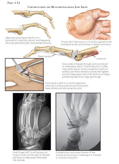 Intermetacarpal Joint