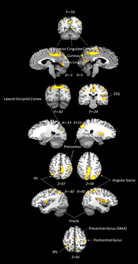 Imaging The Noradrenergic System In Parkinsons Disease A 11c
