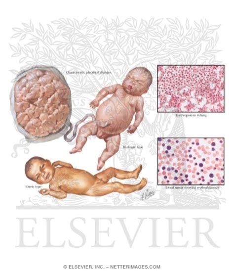 Detail Gambar Eritroblastosis Fetalis Koleksi Nomer 17