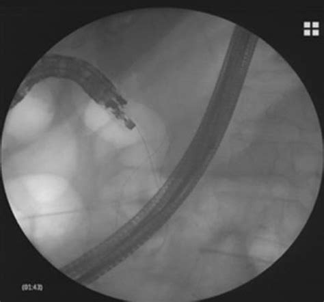 Endoscopic Ultrasound Guided Rendezvous Technique Under Real Time Eus Download Scientific