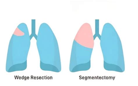 What Is Segmentectomy Surgery Medisuggest
