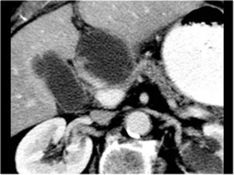 Abdomen And Retroperitoneum 1 2 Gallbladder And Bile Ducts Case 1 2