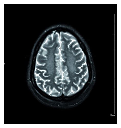 A Dwi Diffusion Weighted Images Bilateral And Symmetric Diffusion
