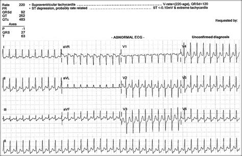 Prehospital Synchronized Electrical Cardioversion Of A Poorly Perfused