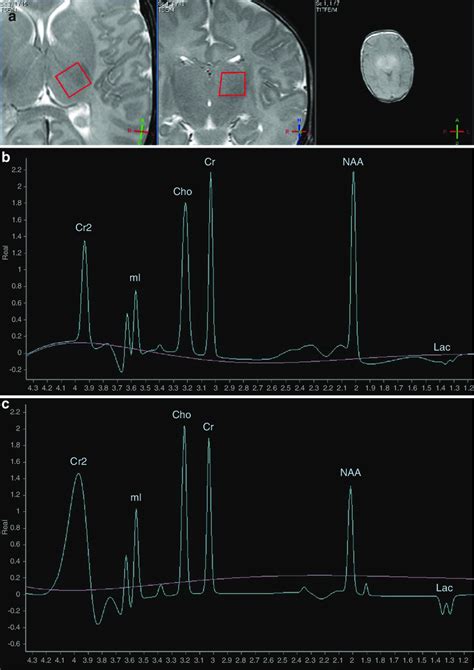 Representative H Mrs Spectra Of Newborns With Moderate To Severe Hie A Download Scientific